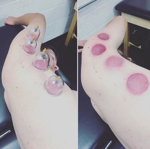 Myofascial Decompression Treatment - Muscle & Joint Clinic